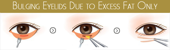 Eyelid Surgery Legend Dr. Kim Byung Gun: [BK Plastic Surgery Hospital ...