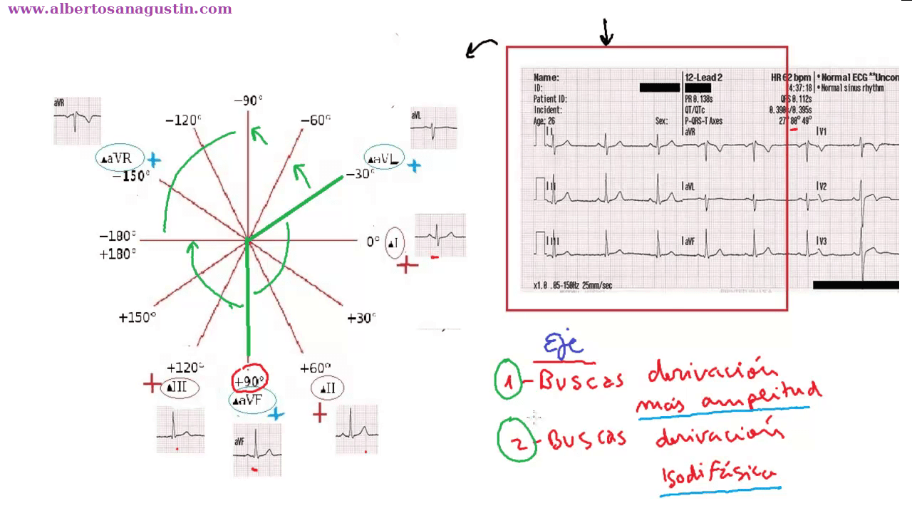 EKG normal (14): Eje eléctrico cardíaco | Dr. Alberto Sanagustín