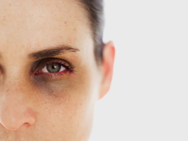 Combat dark circles naturally |beautiful girls magazine 1