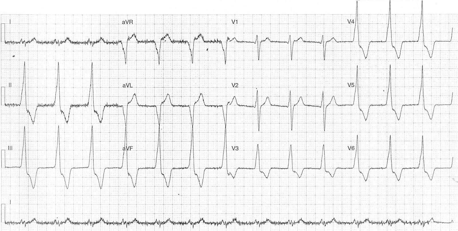 ECG of the Week: ECG of the Week - 7th December 2015 - Interpretation