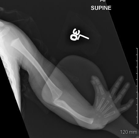 Not the Typical Thumb and Wrist | Congenital Hand and Arm Differences ...