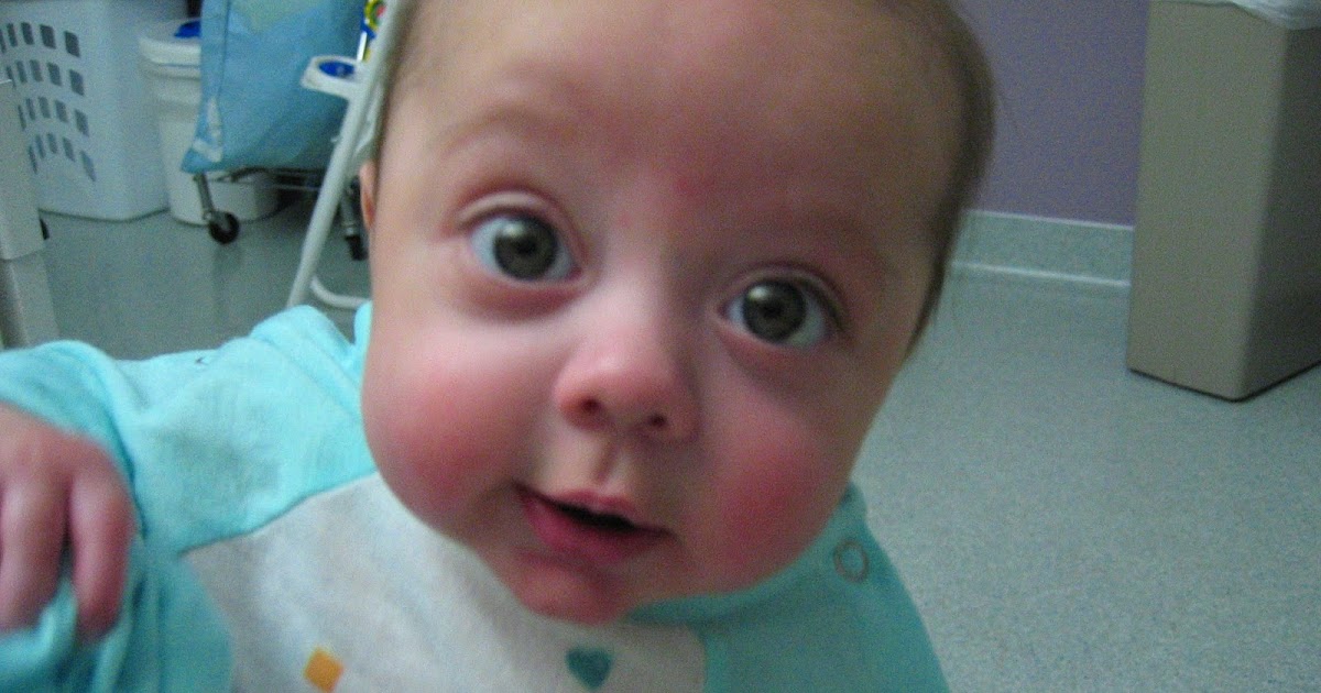 Our little yellow man: Red man syndrome