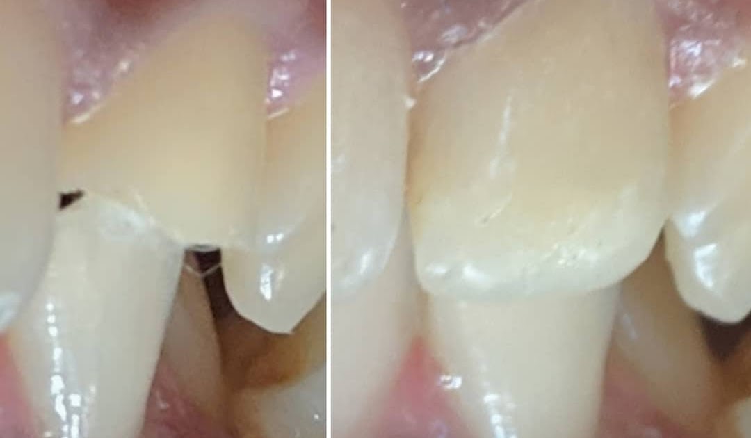 BIO-EMULATION with composite resin