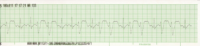 EKG Rhythm Strips 19: Ventricular Ectopy 2