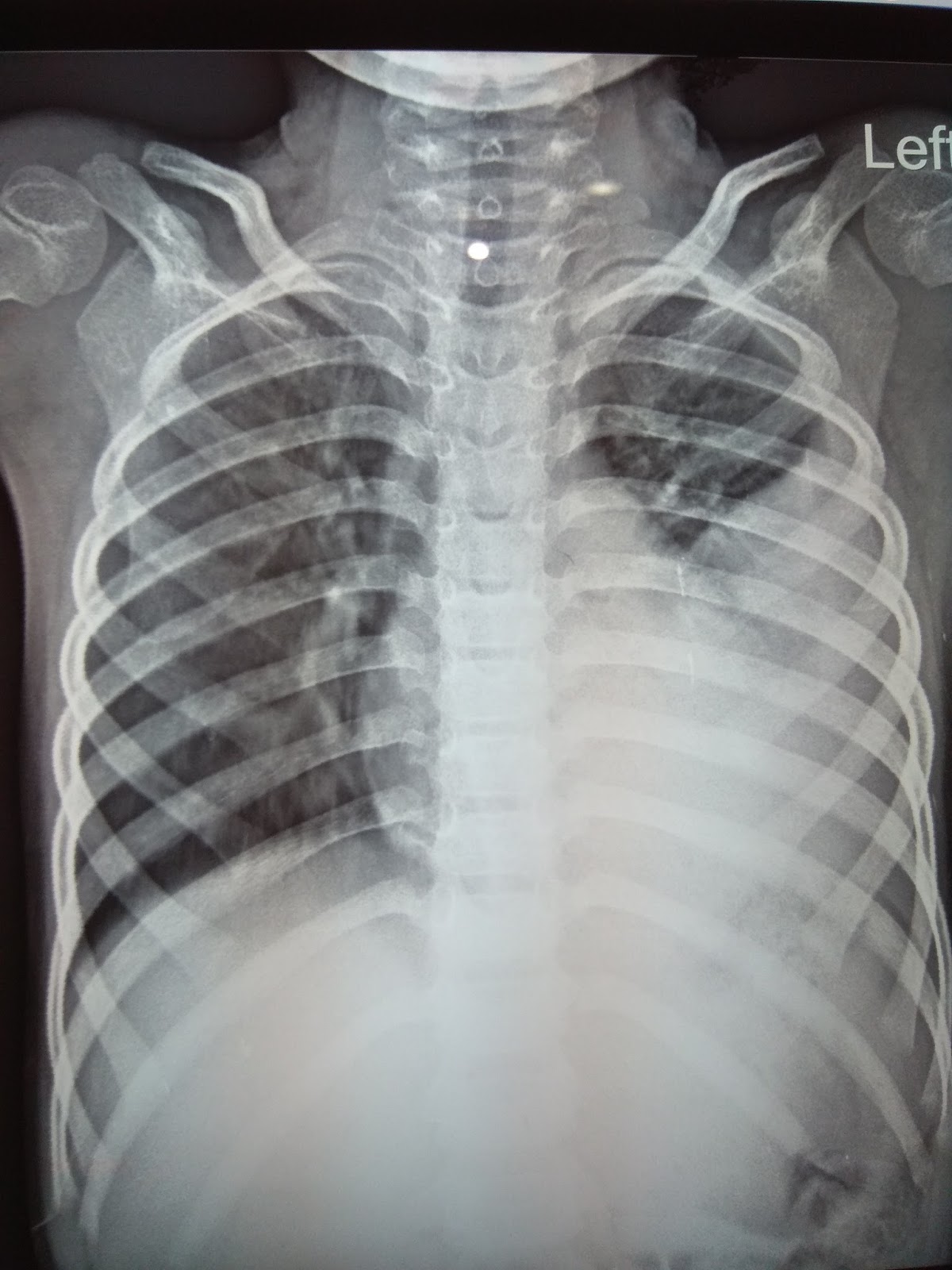 SONO DIGEST: ULTRASOUND CHEST- Empyema thoracis & Enlarged Thymus