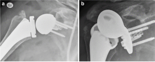 UW Shoulder and Elbow Academy: Reverse total shoulder - dissociation of ...