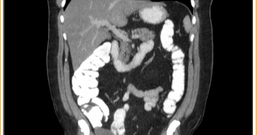 Appendiceal Mucocele: CT - Sumer's Radiology Blog
