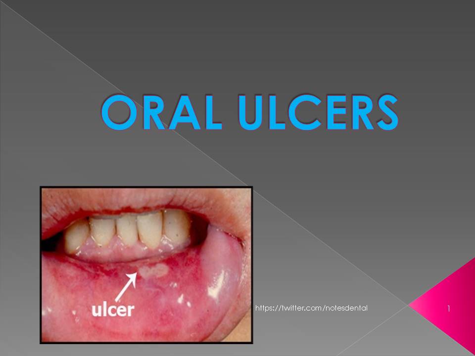 Dental Notes: Oral Ulcers NOTES
