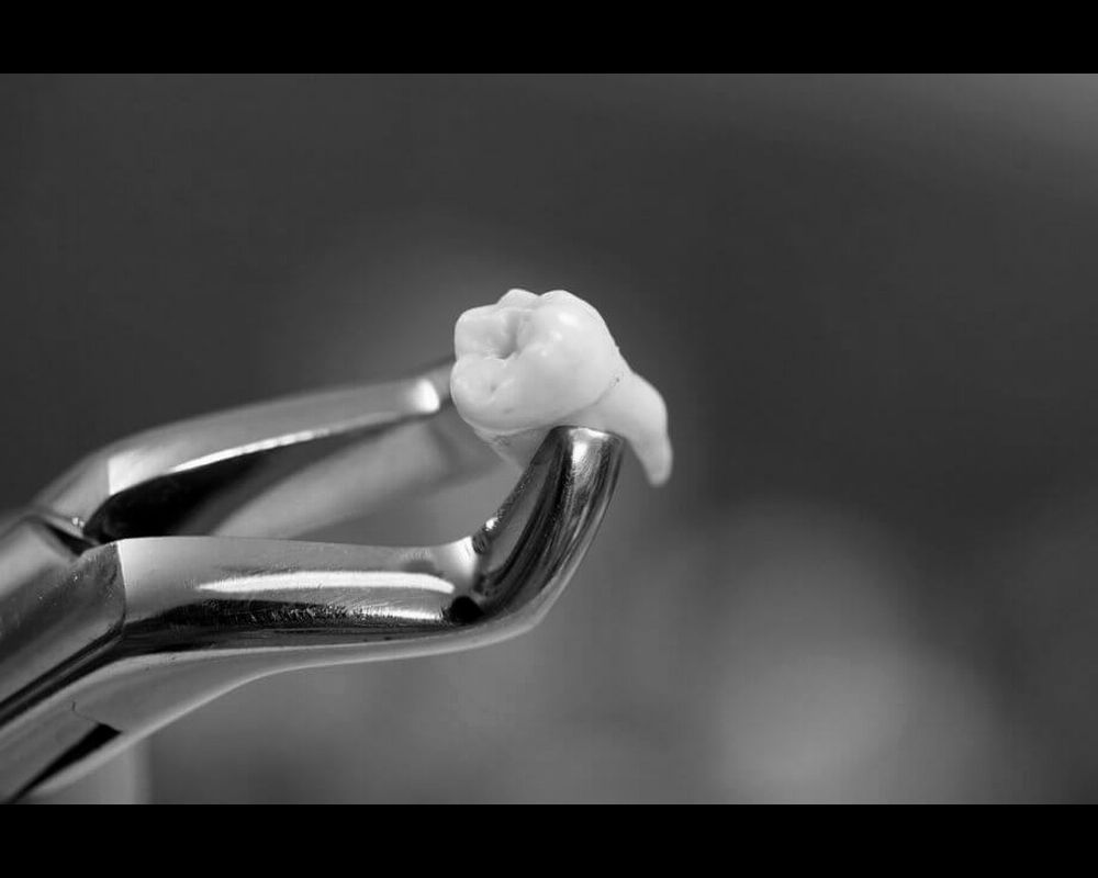 How To Control Bleeding After Extraction OdontoVida how-to-control-bleeding-after-extraction-odontovida