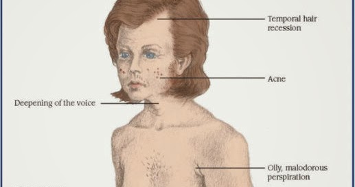 Seputar Penyebab Virilization dan Penanggulangannya - Niotolovo