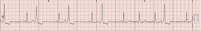 EKG Rhythm Strips 19: Ventricular Ectopy 2