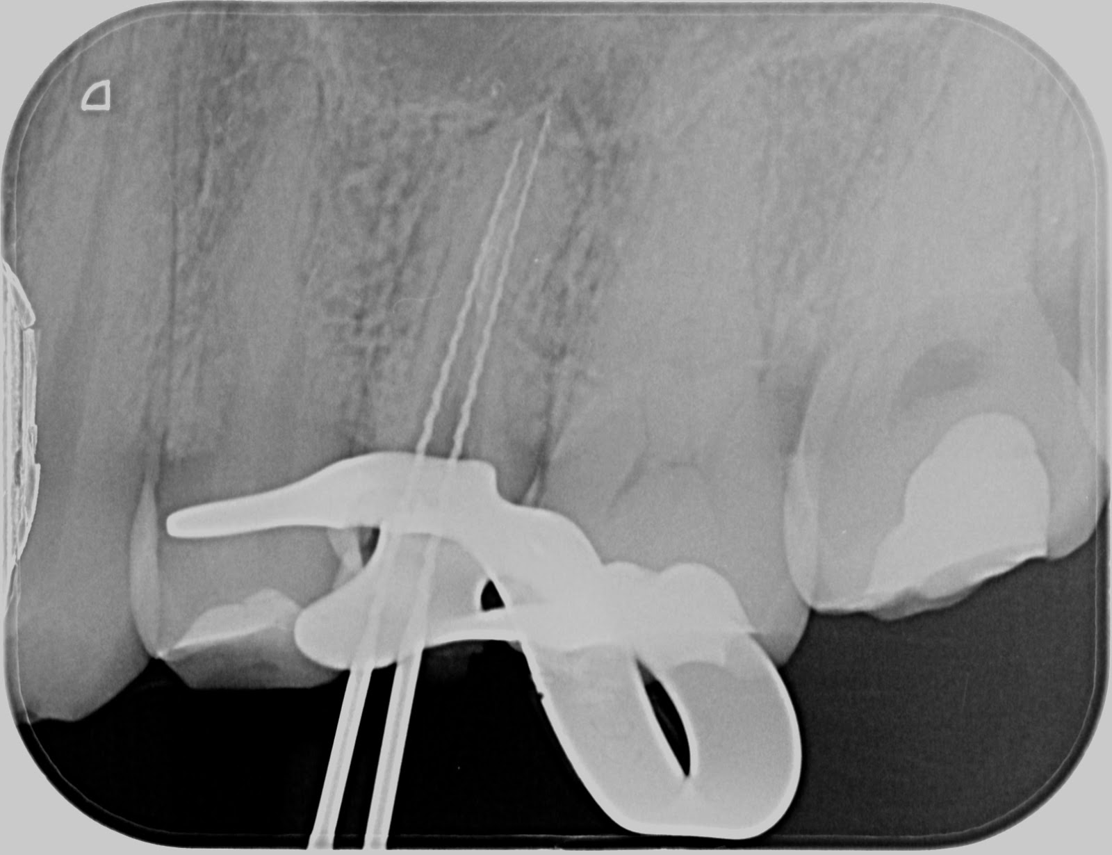 Caso Clínico Master: Despide 2016 salvando un premolar