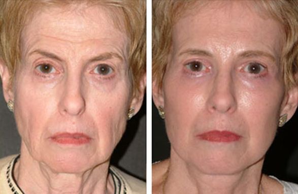 Look Younger With Facial Aerobics Exercises: Ultimate Non-Surgical ...