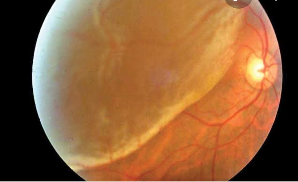 Slit lamp examination technique and illumination type