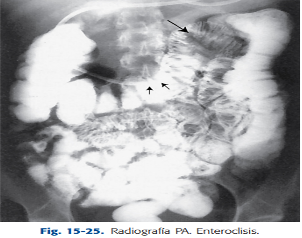 Estudios Contrastados del Sistema Digestivo: Tránsito Del Intestino Delgado