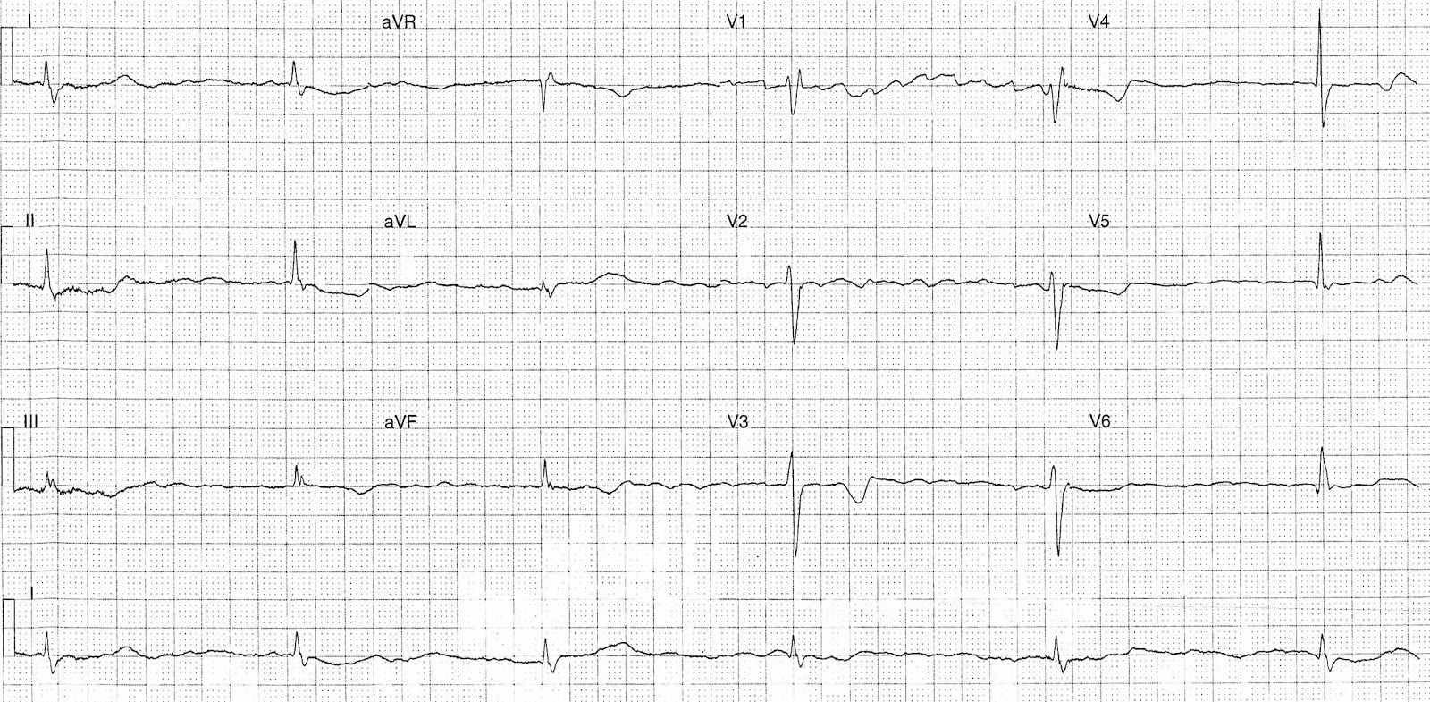 ECG of the Week: ECG of the Week - 17th September 2018