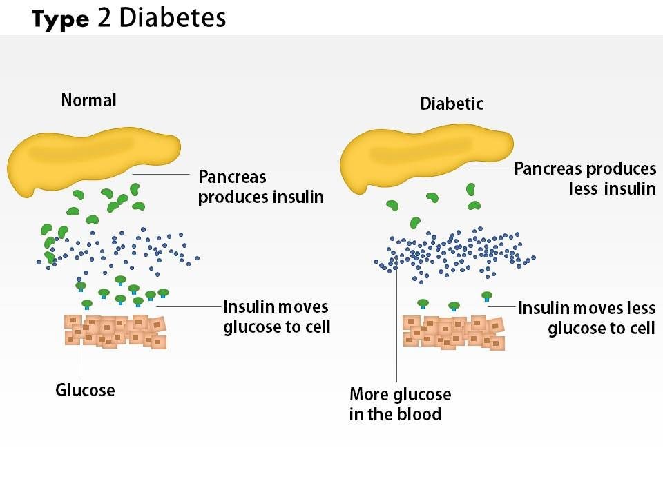 Clusters of Type 2 Diabetes