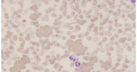 FICHERO HEMATOLOGIA : Aglutinación