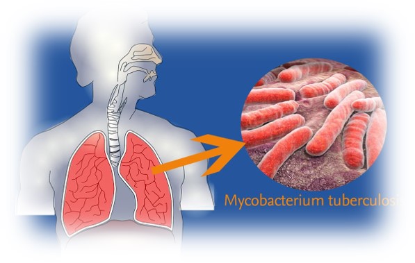 educacionytics: SEMINARIO DE TUBERCULOSIS