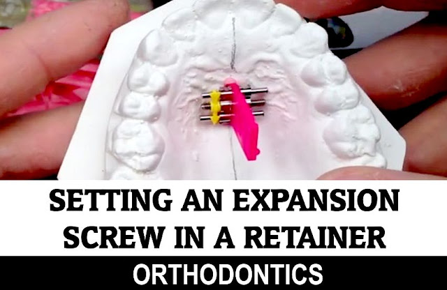 RETAINER: Setting an Expansion Screw