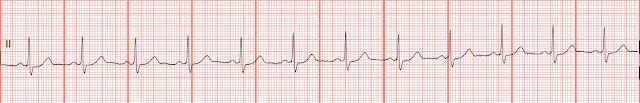 EKG Rhythm Strip Quiz 31