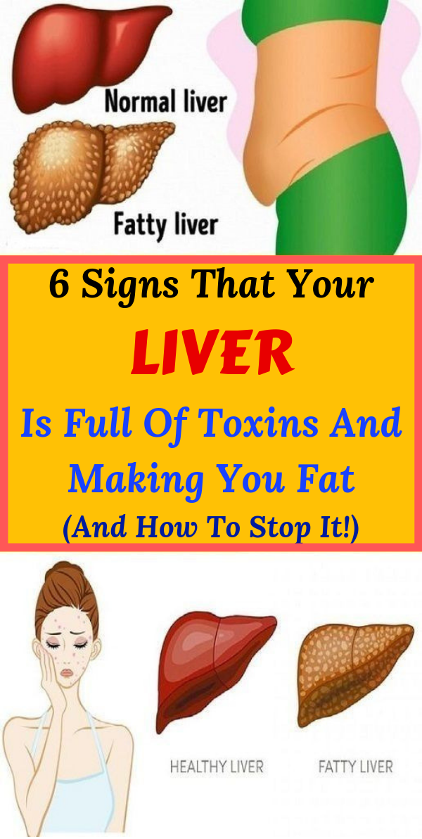 6 Signs That Your Liver Is Full Of Toxins And Making You Fat And How