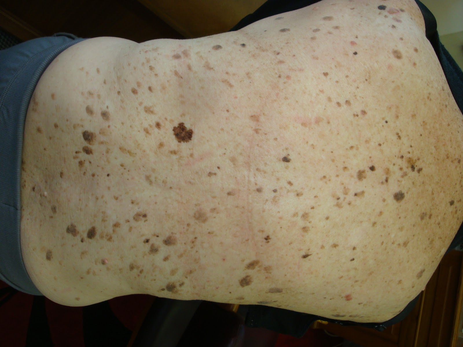 Consultations in Dermatoscopy: Three cases