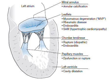 Belajar Kardiologi: Regurgitasi Mitral