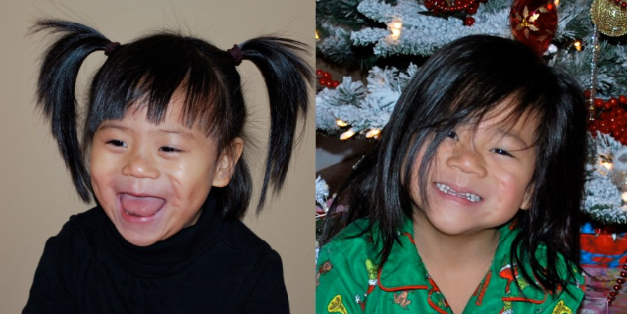 Bring my sons from afar...: BWS - Enlarged Tongue (macroglossia) Bring my sons from afar...: BWS - Enlarged Tongue (macroglossia)
