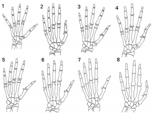 The Shilla Growth Guidance Procedure | Growing Spine Blog | Washington ...