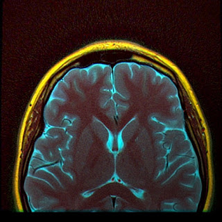 Nevit's blog: Color MRI of Orbita