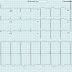 Cardiac Risk Assessment Prior to Noncardiac Surgery Case File