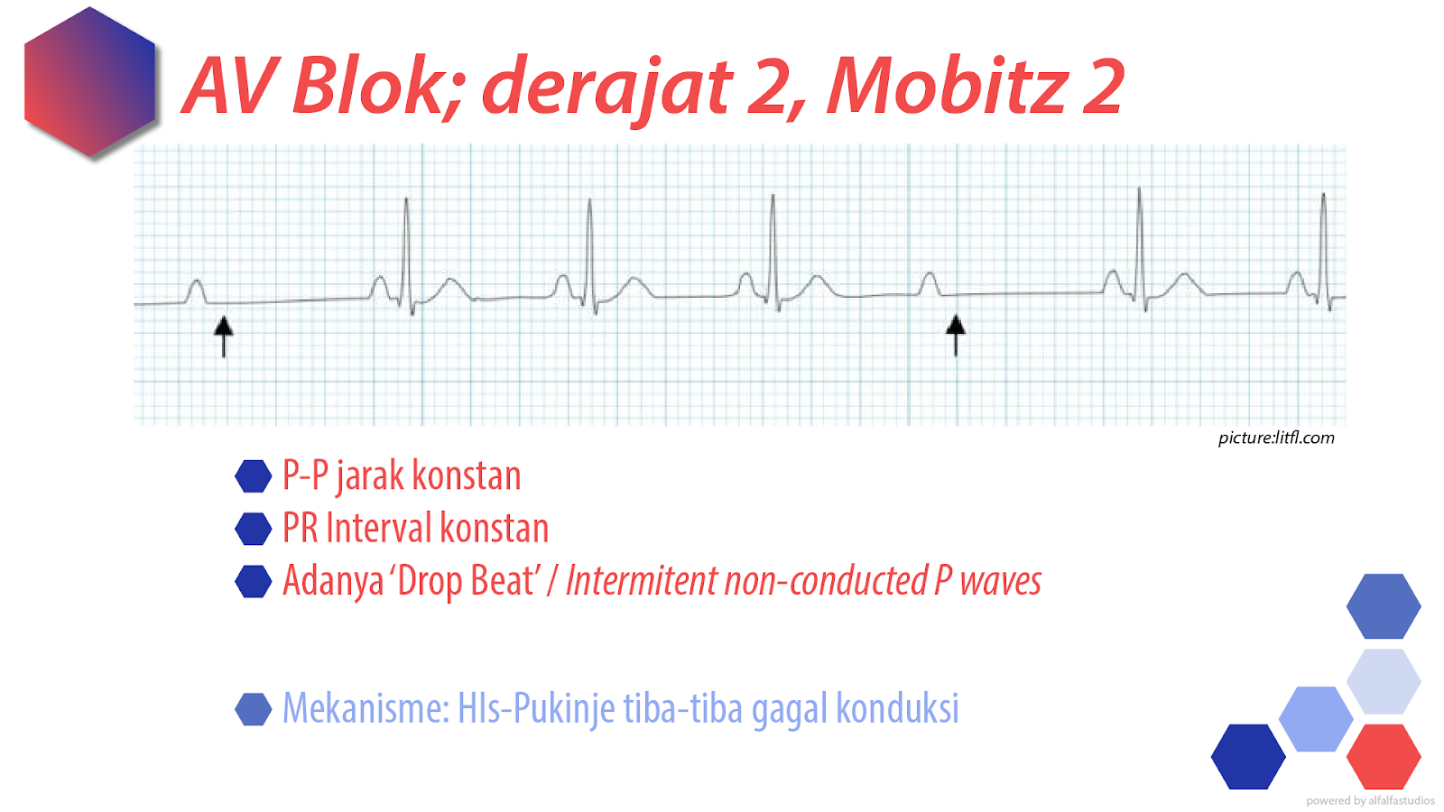Conduction Block; AV Block & Bundle Branch Block; Workshop EKG | Dokter ...