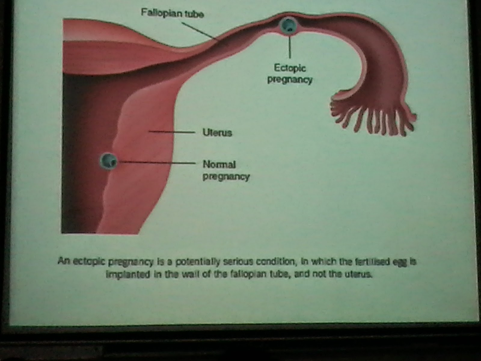 Lecture slides: Surgery: Ectopic pregnancy
