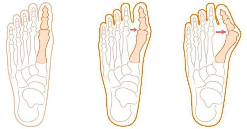 Come risolvere il problema dell’alluce valgo - Alimentazione salute