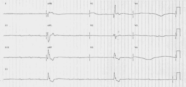 Idioventricular Rhythm | INA - ECG