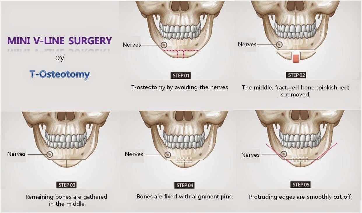ID Hospital Korea: What is Mini V-Line Surgery?