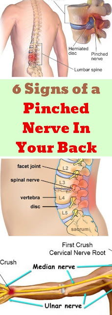 Here Are 6 Signs Of A Pinched Nerve In Your Back Famous Comedy Humor