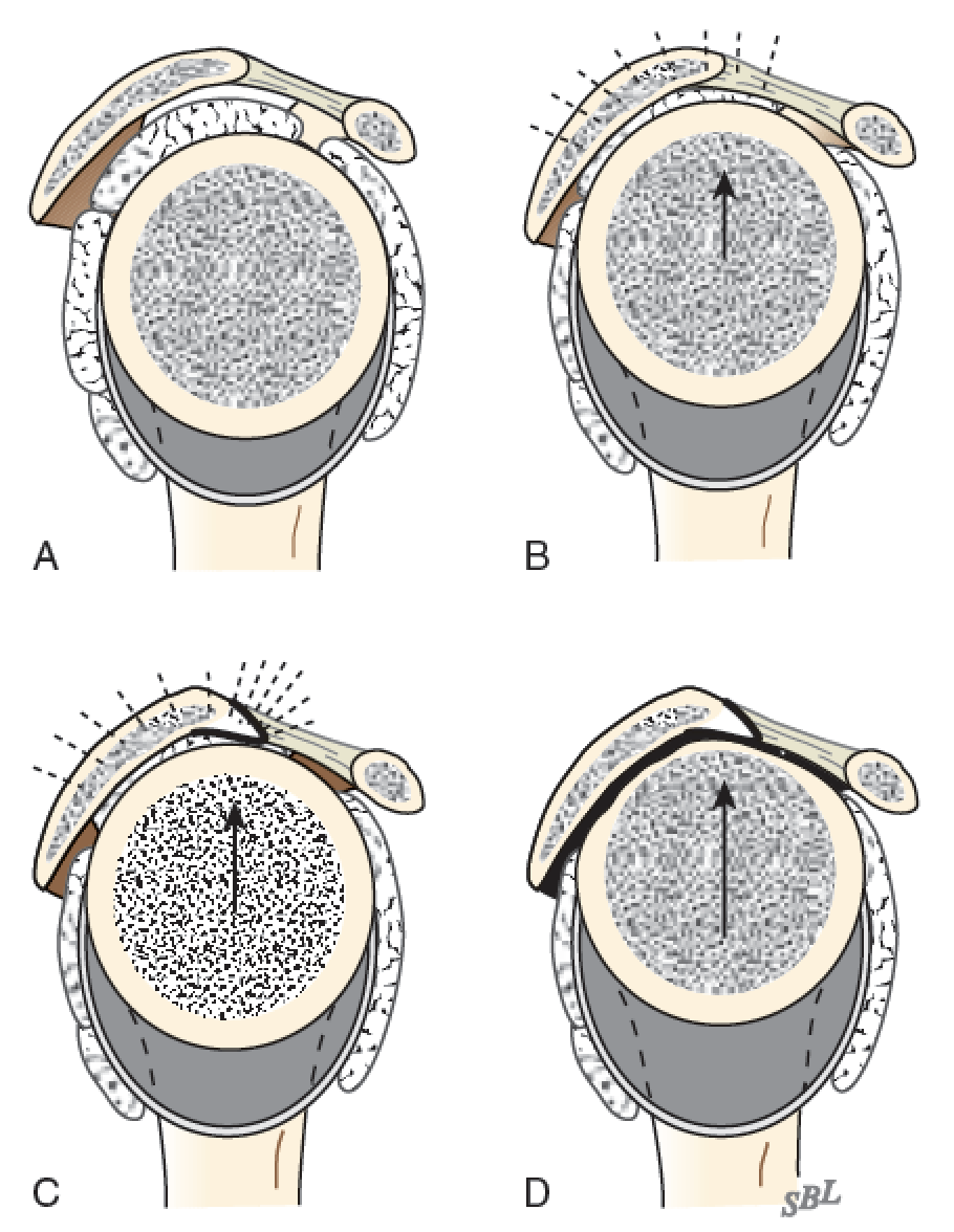 Shoulder Arthritis / Joint Replacement : Superior capsular ...