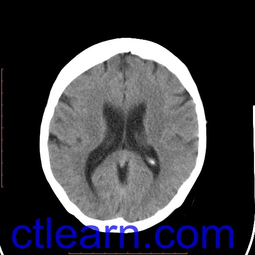 Diagnosis of a CT scan on the brain, with the report -2