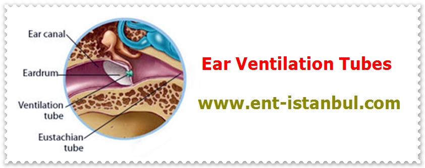 Ear Ventilation Tubes