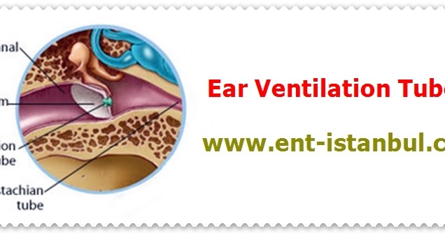 Ear Ventilation Tubes