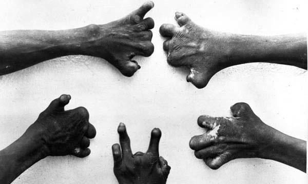 SA1 + SA2 - Sociedade Tecnologia e Ciência: A Lepra