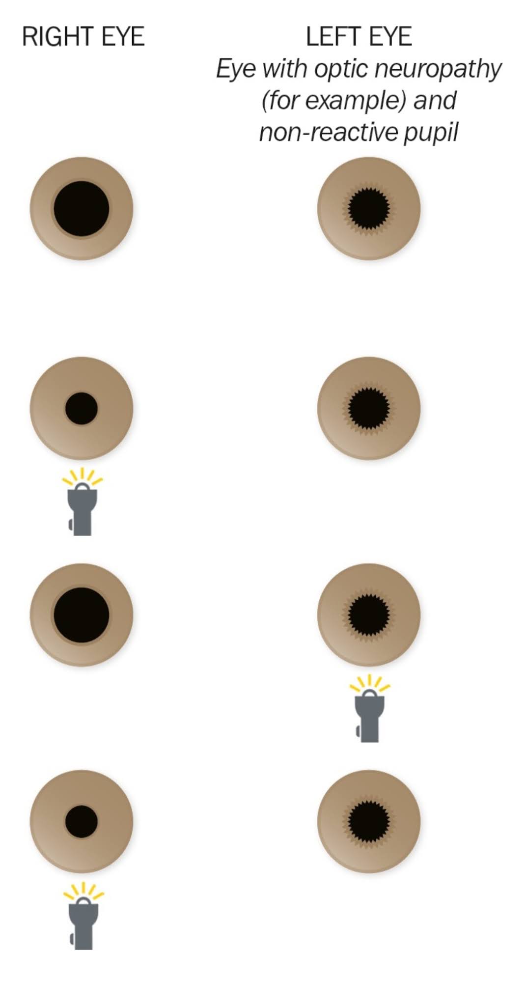 Common causes of RAPD