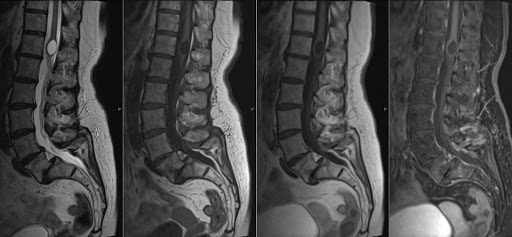 Ventriculus Terminalis - Fifth Ventricle