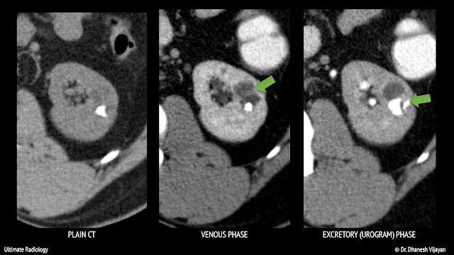 Ultimate Radiology : Calyceal Diverticulum