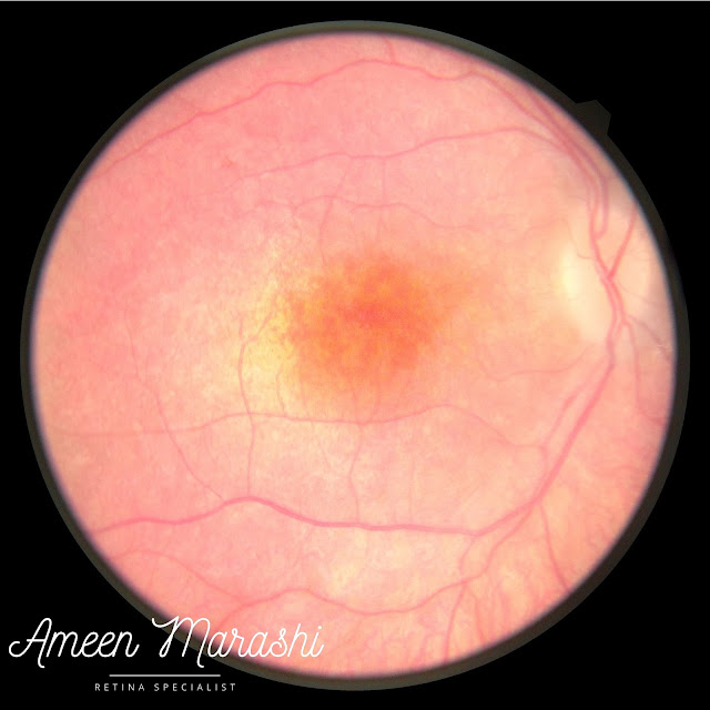 Cone-Rod Dystrophy an example of RPE atrophy due to cone-rod dystrophy