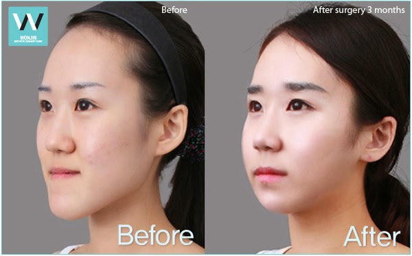 Long face correction before and after