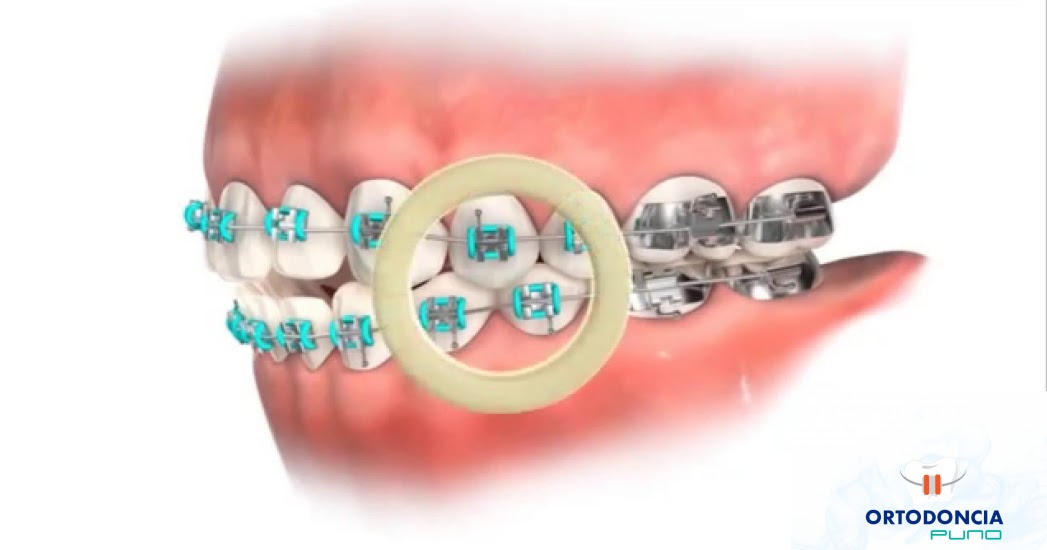 ¿Qué son los elásticos intermaxilares? Aquí te lo explicamos ...