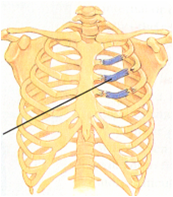 learn nursing: chest injuries,Symptoms and first aid for chest injuries